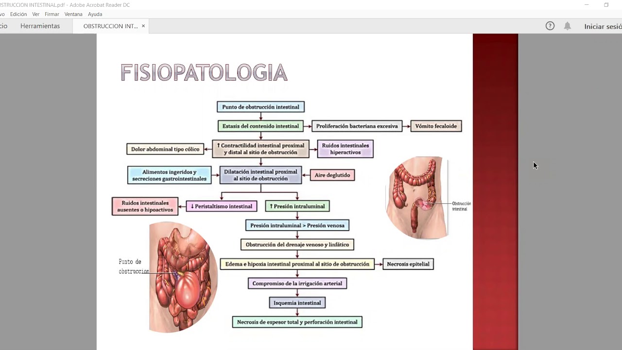 obstrucción intestinal - YouTube
