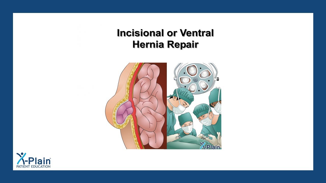 Incisional or Ventral Hernia Repair - YouTube