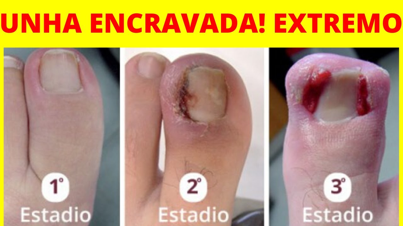 Desencravar unhas, unha encravada, unha encravada inflamada, pomada ...