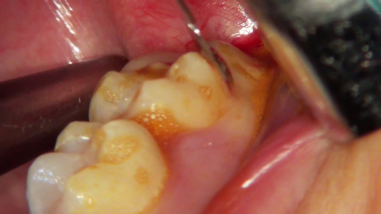 Double wisdom tooth - YouTube