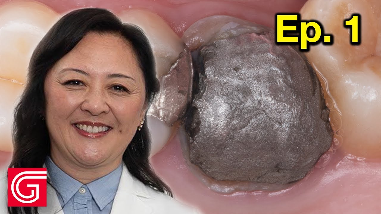 Removing OLD Amalgam Restoration on Tooth #|14 Ep1 - YouTube