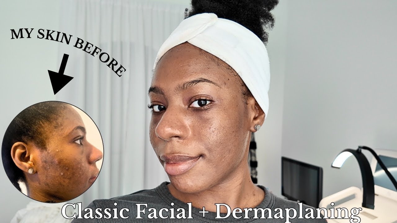 Classic facial & Dermaplaning for Acne prone skin | texture, dark spots ...