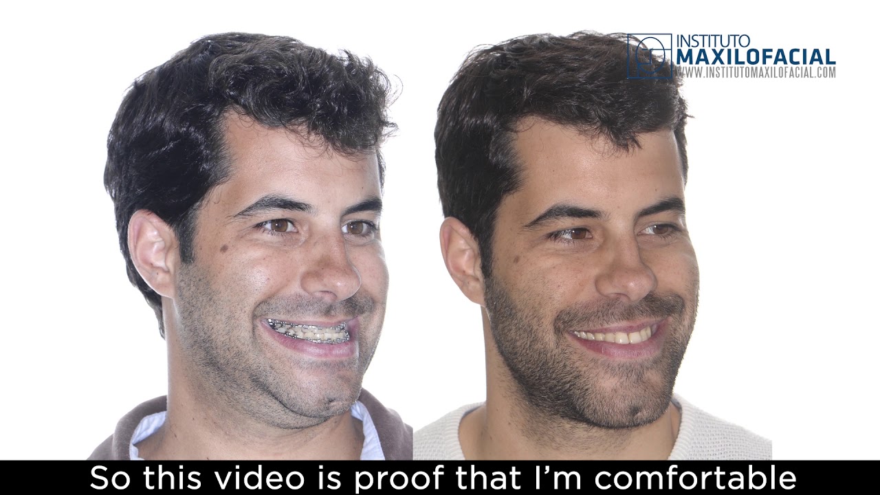 Orthognathic bimaxillary surgery. Case # 67: Ivan- Class III bite ...