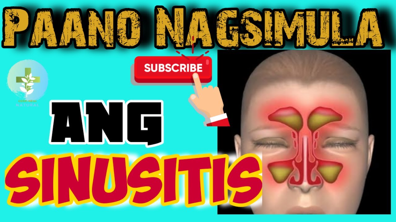 Paano Nagsimula ang SINUSITIS ? - YouTube