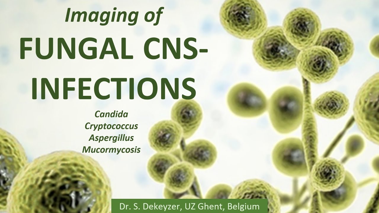 Imaging of fungal brain infections - YouTube