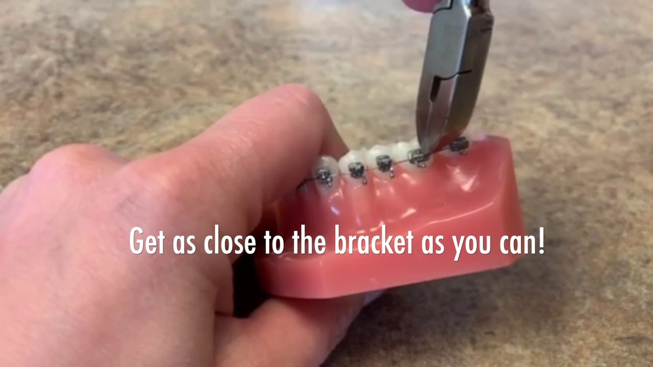 Fixing Those Pesky, Pokey Wires! | Braces and Invisalign | Northglenn ...
