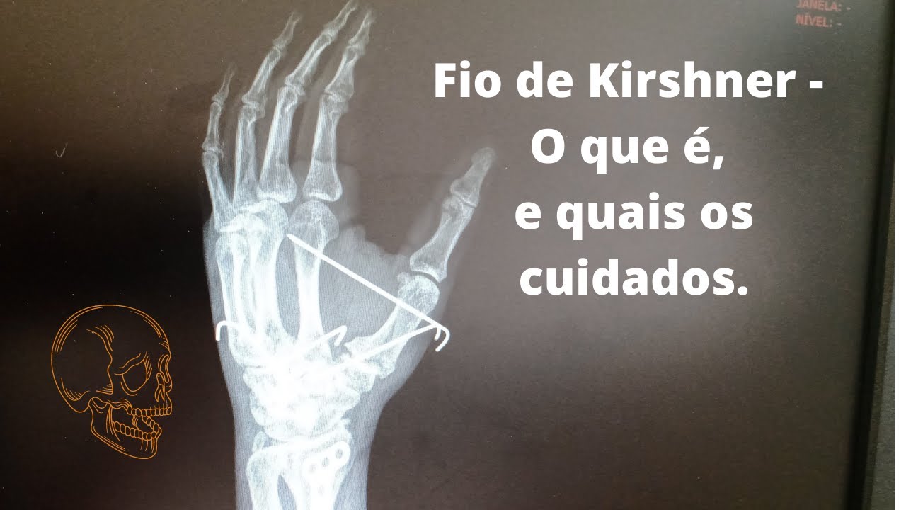 Fio de Kirshner - O que é, e quais os cuidados. - YouTube