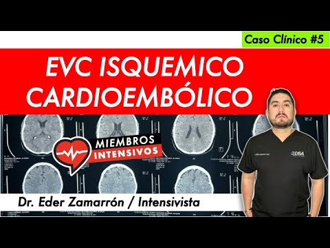 Caso clínico #5 EVC isquémico By Dr. Zamarrón - YouTube