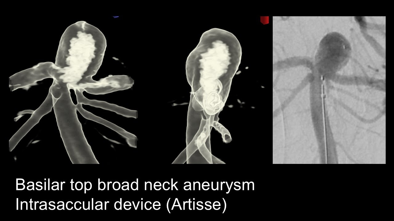 Aneurysm Basilar Top - Intrasaccular - YouTube