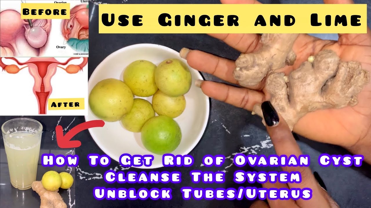 How To Get Rid Of Ovarian Cyst Natural 2 Ingredients At Home. #natural ...