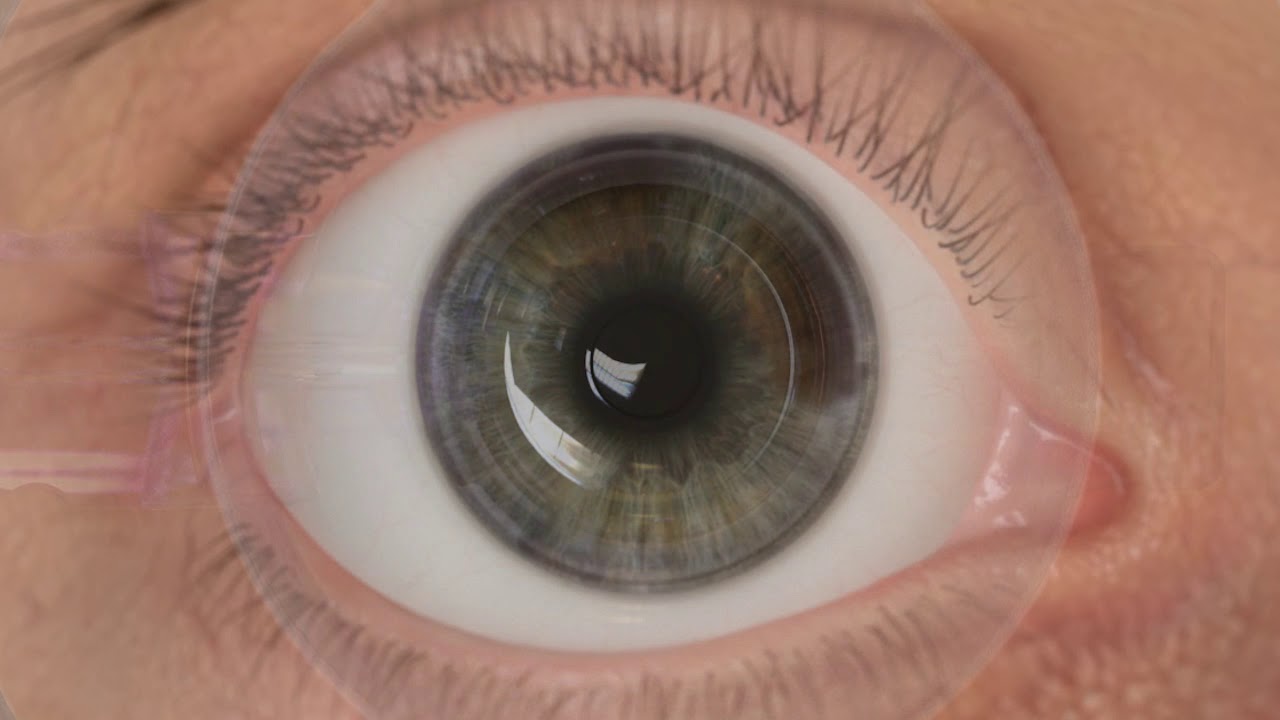 LASIK using the Alcon WaveLight Refractive Suite - YouTube