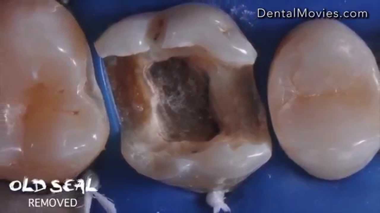 Re-endo and on-lay - YouTube