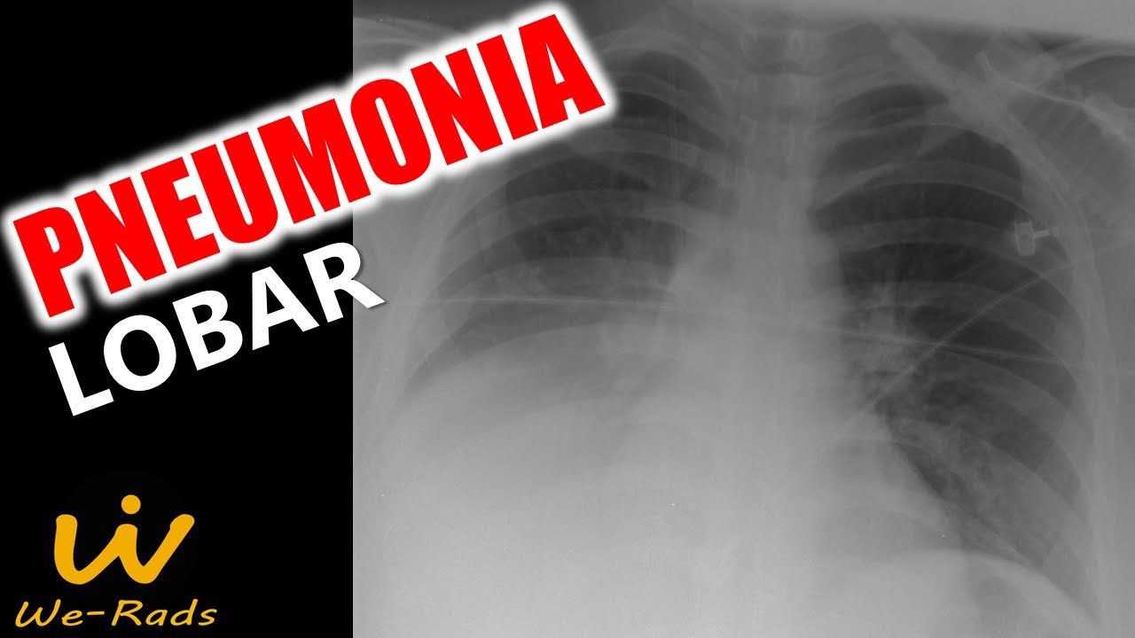 Pneumonia Lobar no Raio-X e na Tomografia Computadorizada de Tórax ...