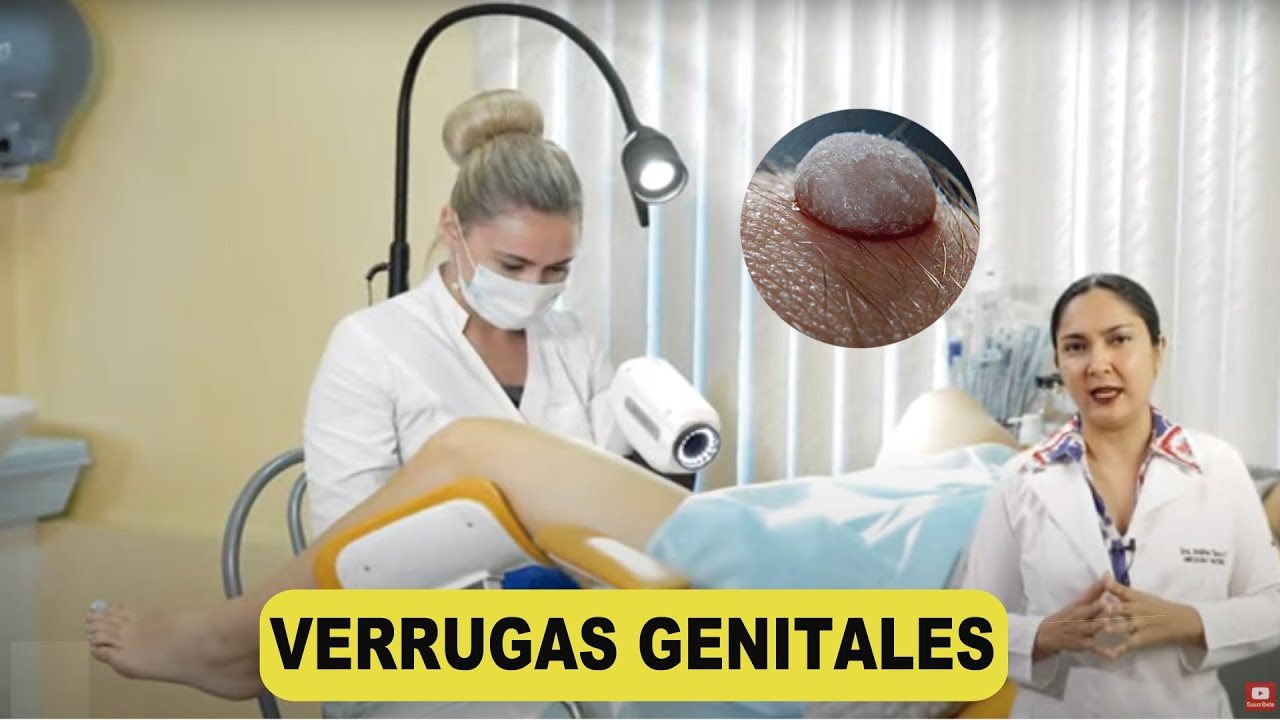 Verrugas en Genitales - VPH - Condilomas - Papiloma Virus - YouTube