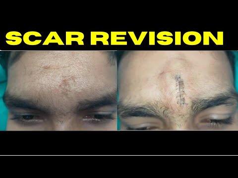 scar revision surgery| Scar on forehead| laser scar revision surgery ...