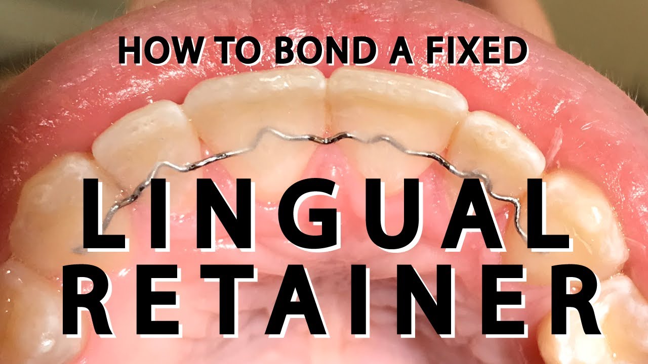 Orthodontics: How To Bond A Fixed Lingual Retainer - YouTube