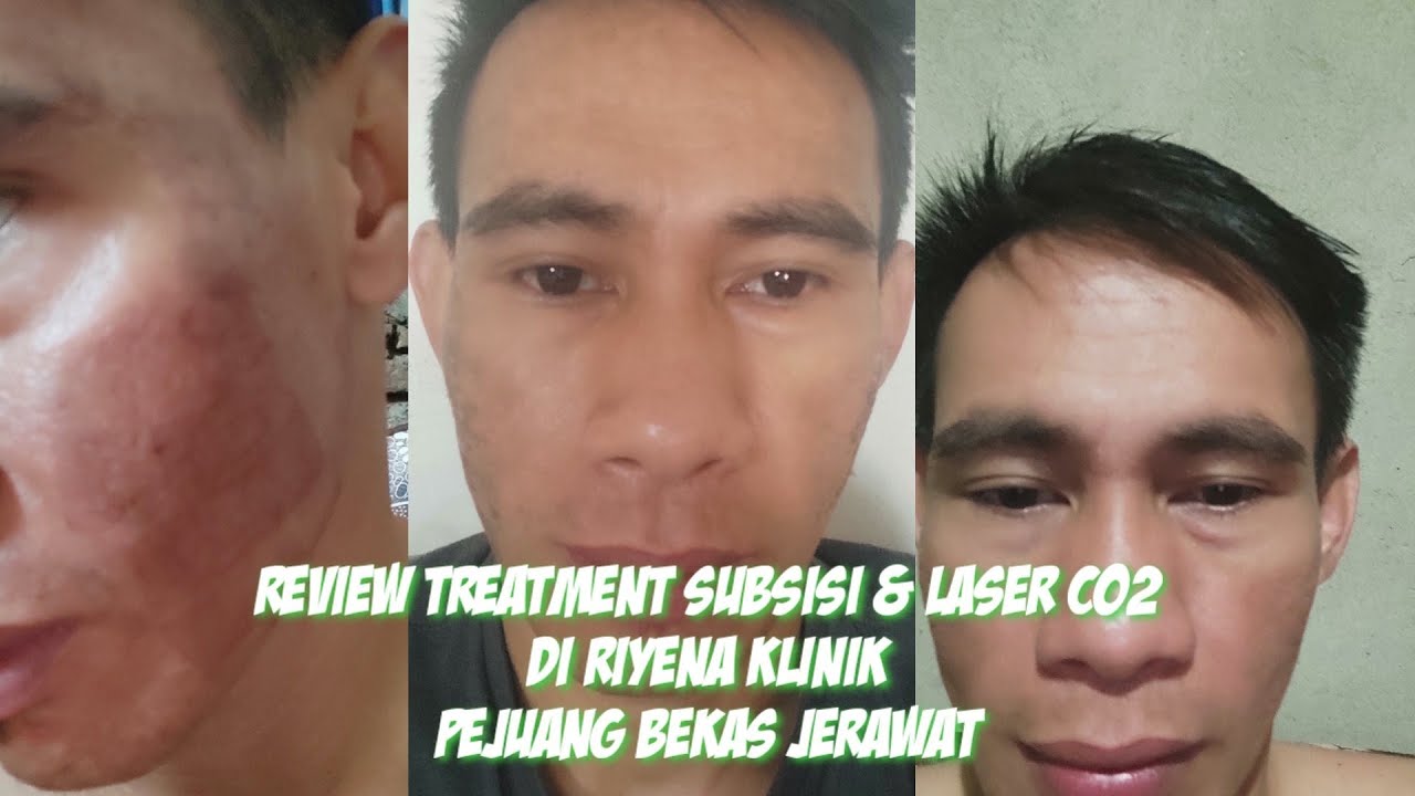 Review treatment subsisi & laser co² di RiyenA klinik_ bekas jerawat ...
