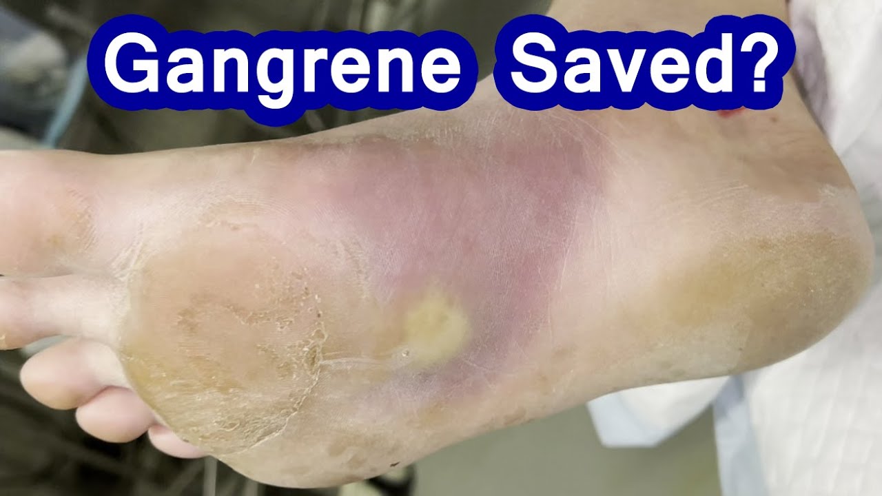 Gangrene Foot Before After Video #diabeticfoot #diabeticinfection - YouTube