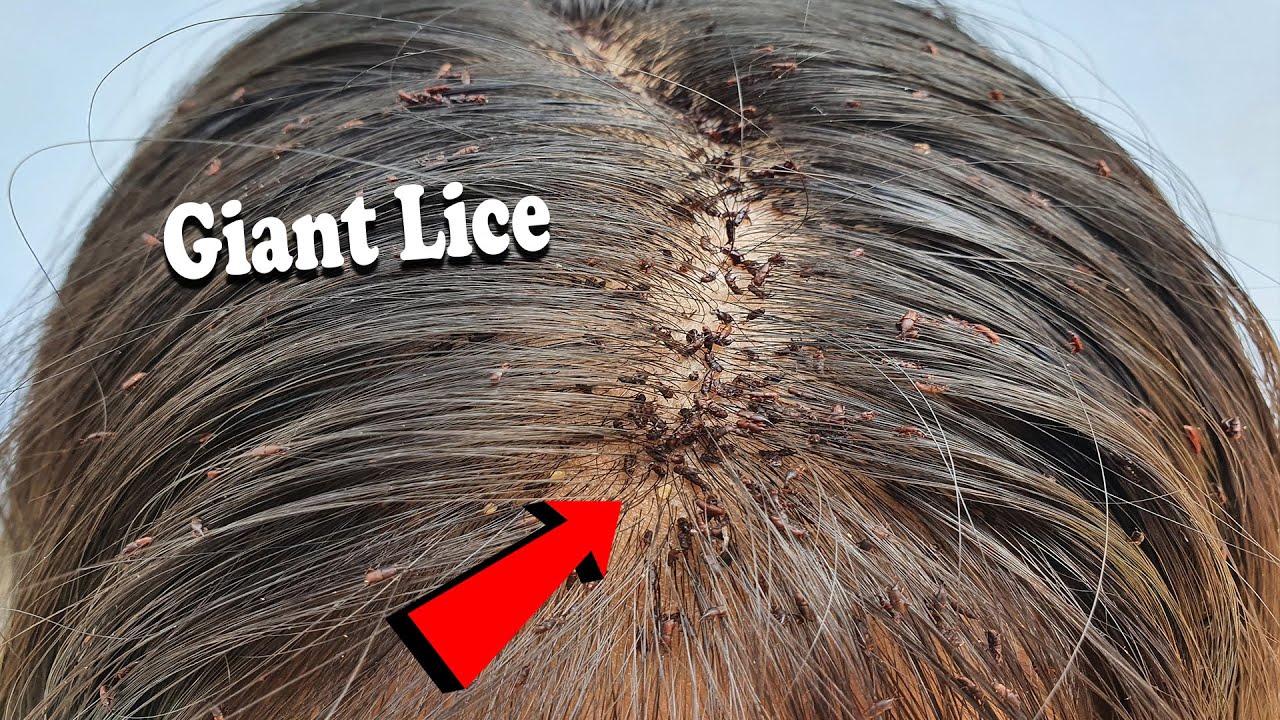 Beautiful long extremely damage - Lice Conbing - YouTube