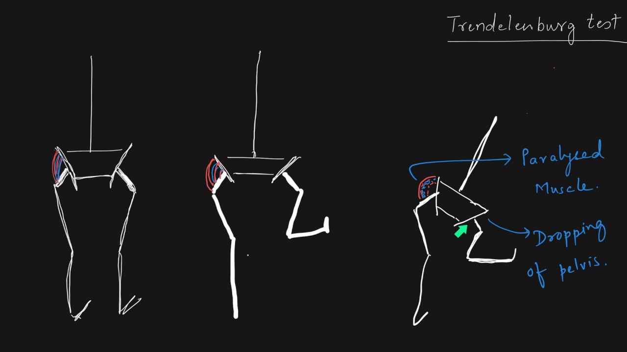 Trendelenburg test - YouTube