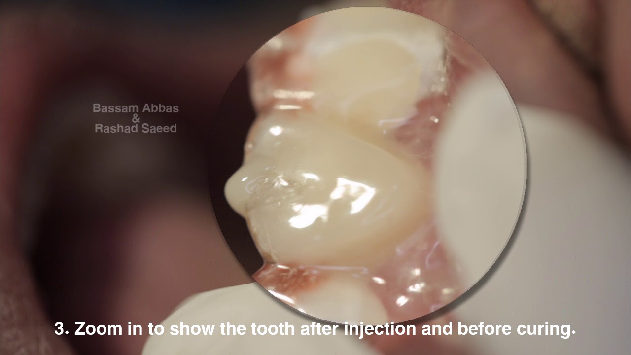 Composite veneer using Injection technique - YouTube