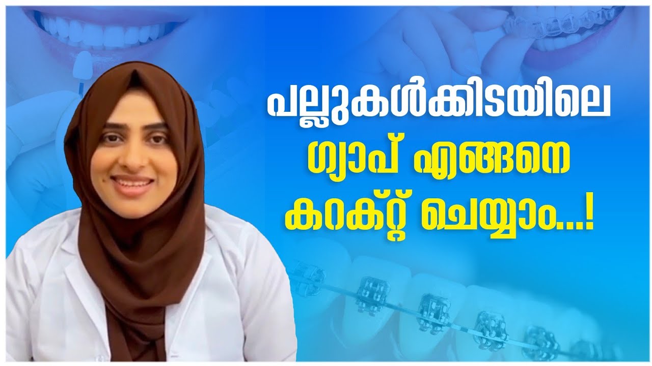 പല്ലുകൾക്കിടയിലെ GAP എങ്ങനെ CORRECT ചെയ്യാം......!DR TALK || DR SOUDA ...