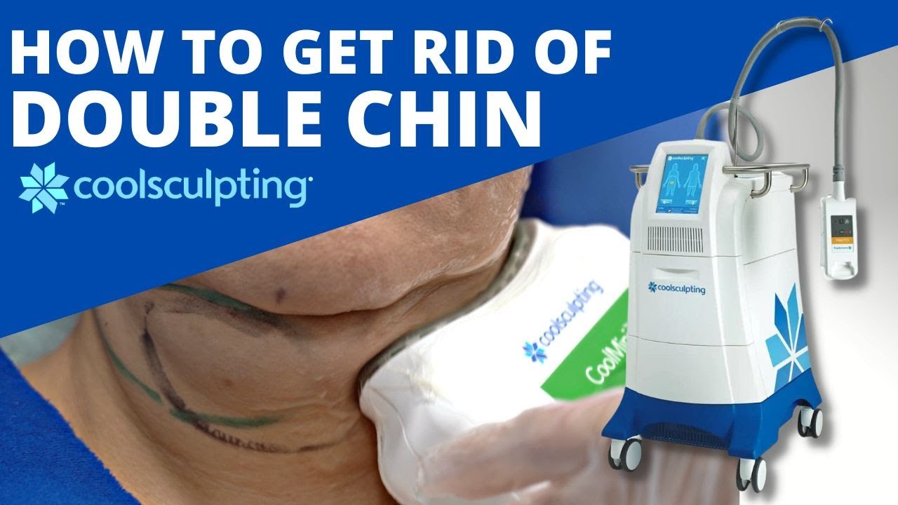 Double Chin Fat Reduction using CoolSculpting. - YouTube
