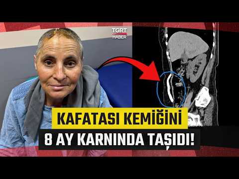 Hayat Kurtaran Sıradışı Operasyon! Kafatası Kemiğini 8 Ay Karnında Taşıdı - TGRT Haber