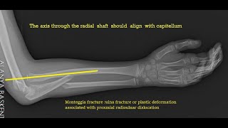 Monteggia Y Galeazzi Monteggia Fracture: Practice Essentials, Anatomy,