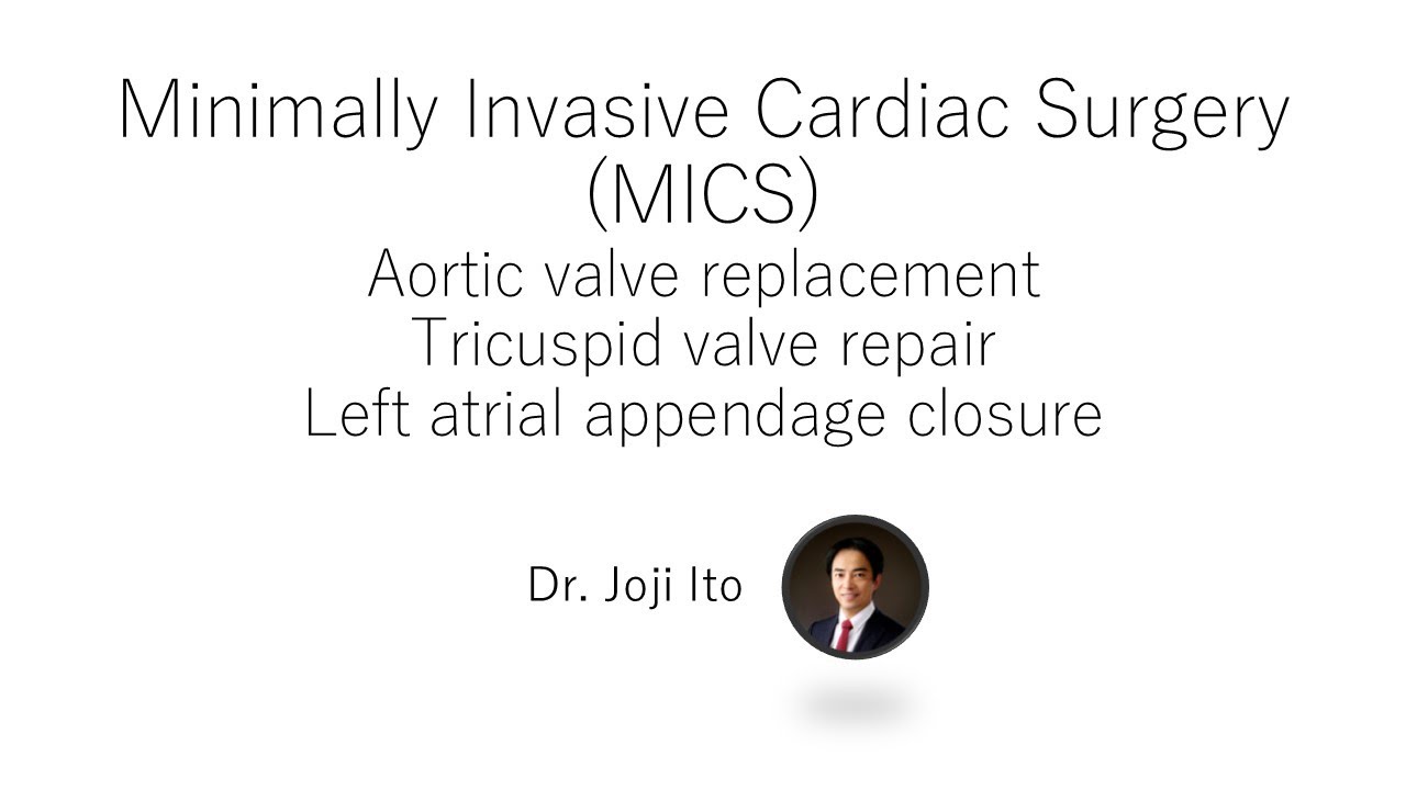 Minimally invasive cardiac surgery; AVR, TVP, LAA closure - YouTube