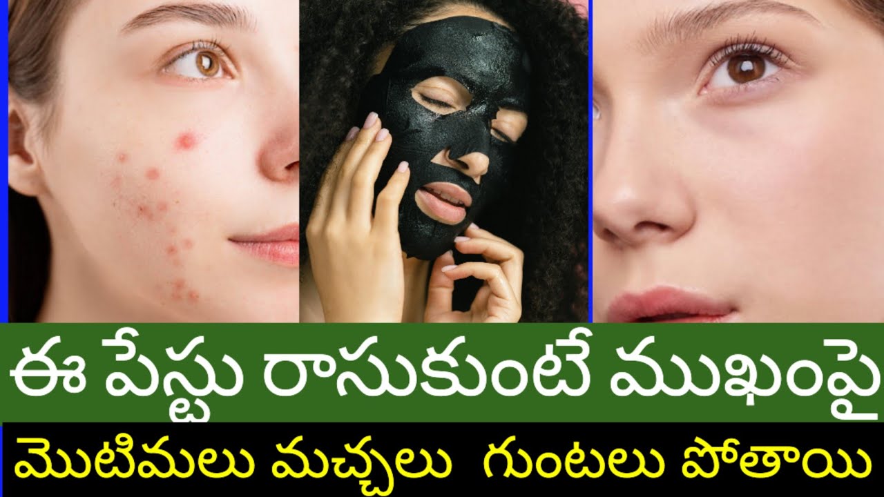 Remove Pimples and Acne Scars by Homemade/Face pack/Dark Spots - YouTube