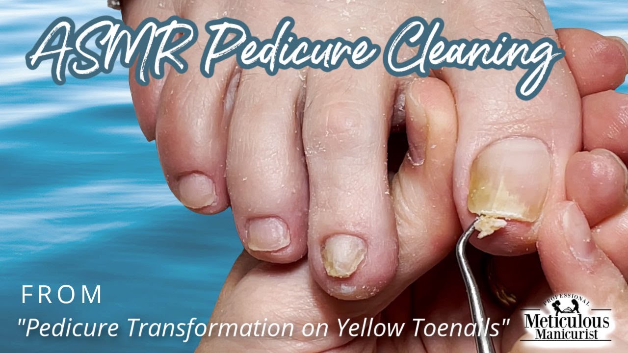 👣ASMR Pedicure Cleaning 💆‍♀️ Pedicure Transformation on Yellow Toenails ...