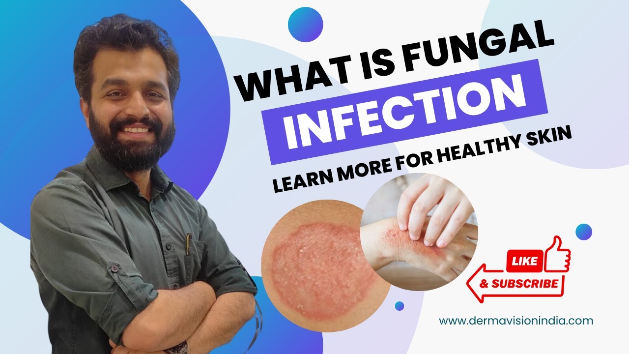 ( Fungal Infection)फंगल इन्फेक्शन क्या होता है || Explained by Dr ...