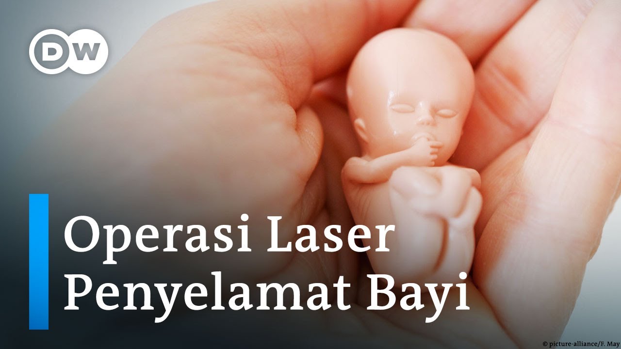 Teknologi Laser Untuk Operasi Janin - YouTube