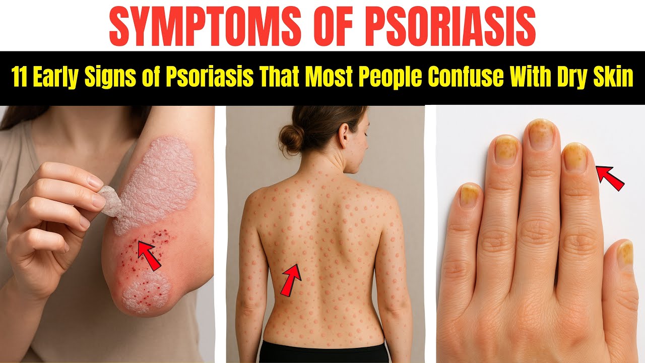 11 Early Signs of Psoriasis That Most People Confuse With Dry Skin ...