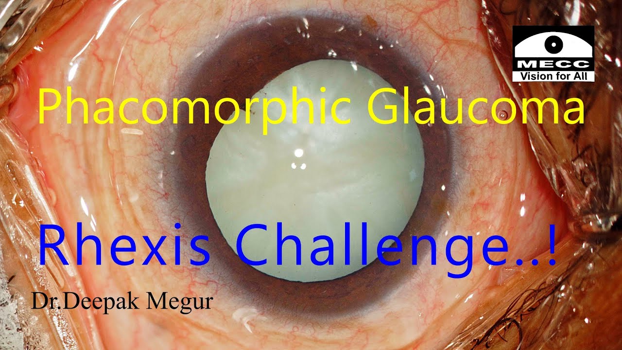 Phacomorphic Glaucoma: Rhexis Challenge..! Dr Deepak Megur - YouTube
