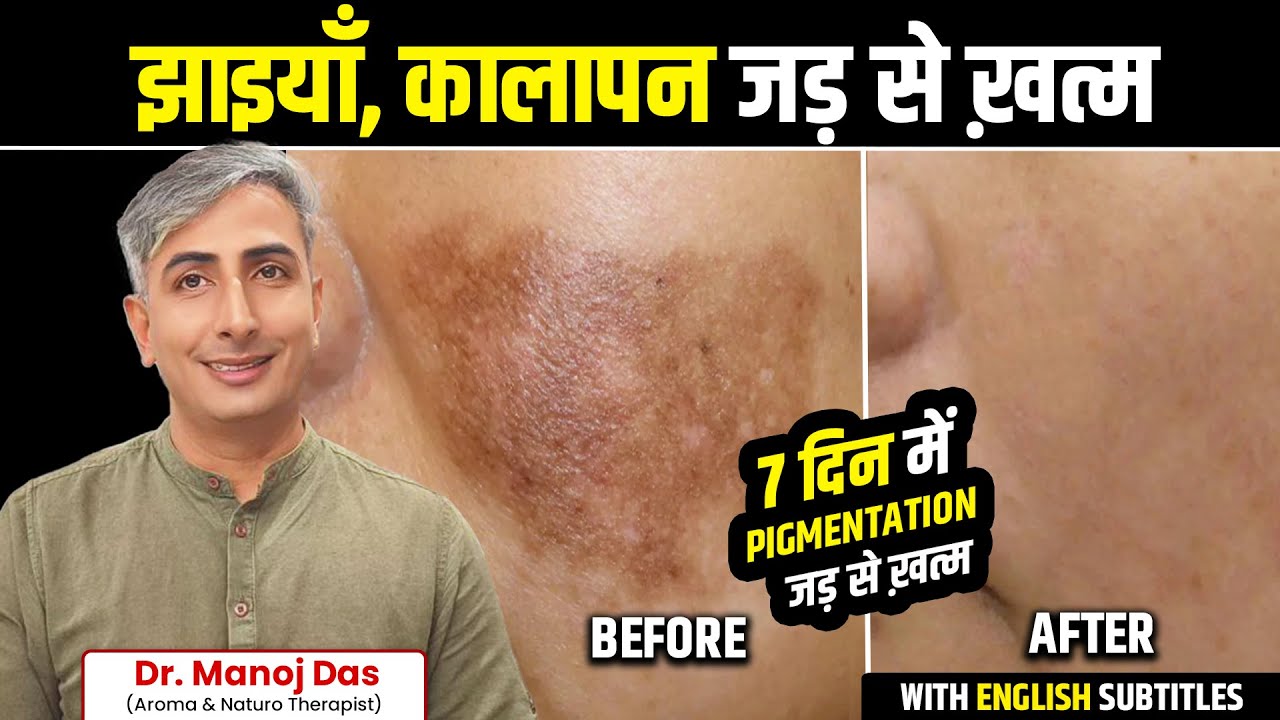 घर पर सिर्फ़ 7 दिन में ज़िद्दी पिग्मेंटेशन हटाये | Pigmentation Treatment at Home | Dr. Manoj ...