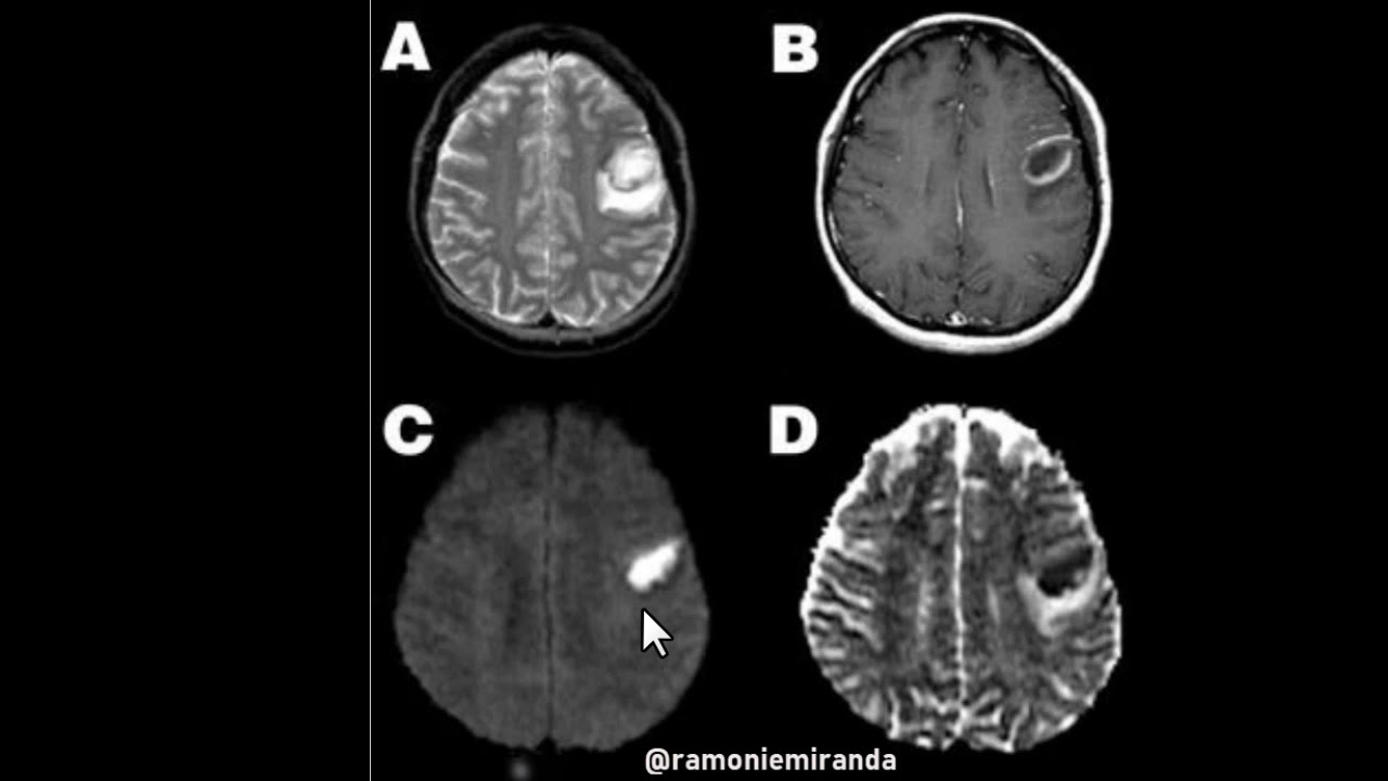 Abscesso Cerebral na Ressonância Magnética - YouTube