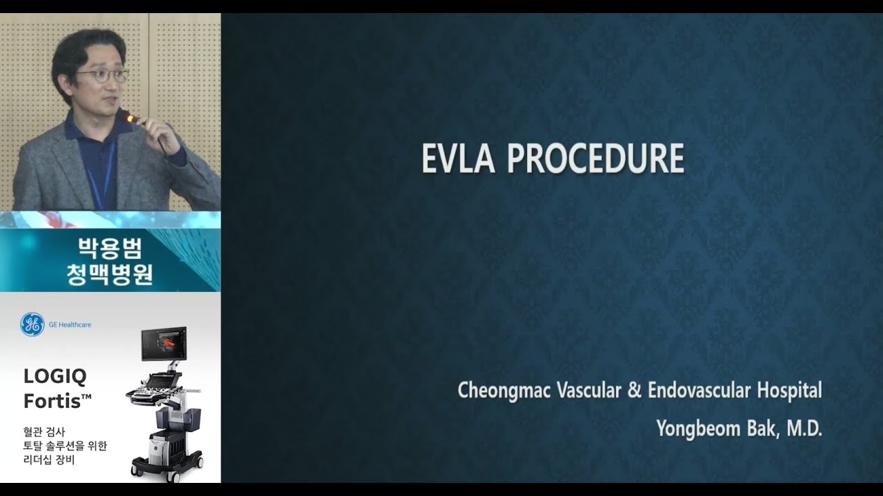 EVLT procedure - YouTube