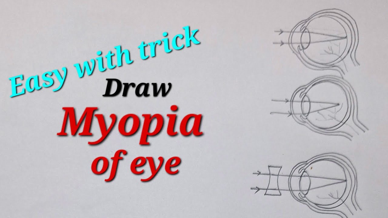 Myopia of eye drawing , How to draw Myopia of eye easy, Myopia drawing ...