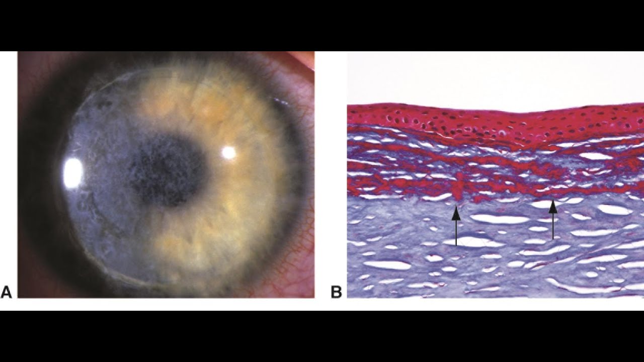 Distrofia Corneana De Reis Buckler Clinical Diagnostic Dilemma Between