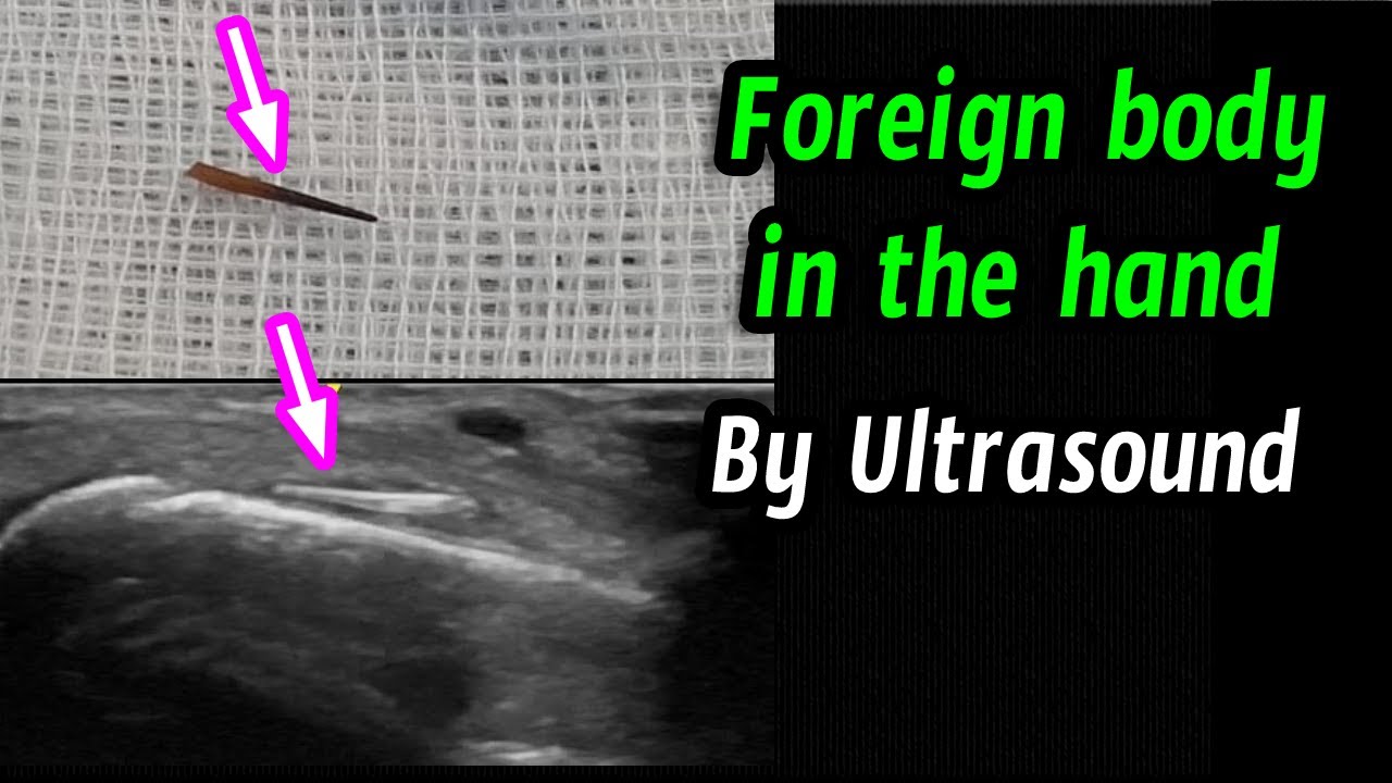 Foreign body in the hand by ultrasound - YouTube