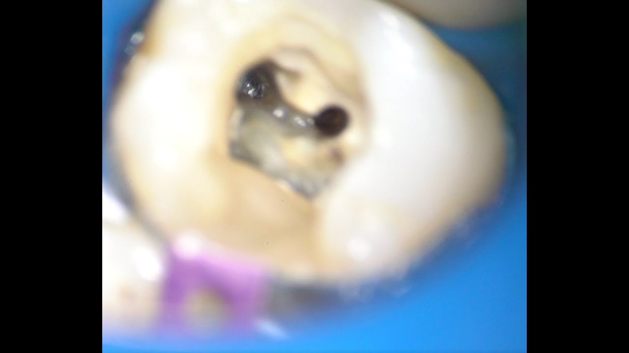 [French] Ma technique pour le retrait d'instruments - Traitement 26 ...