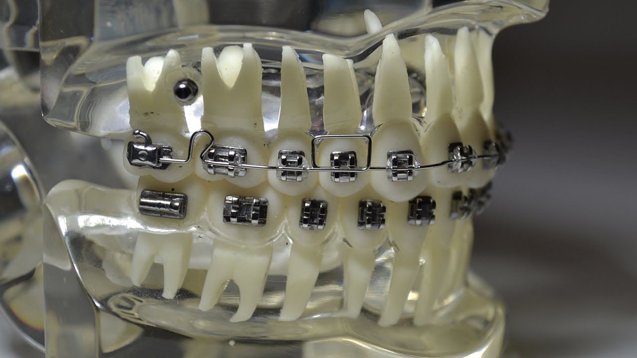 BOX LOOP AND BULL LOOP ORTODONTIA / ORTHODONTIC / ORTODONCIA - YouTube