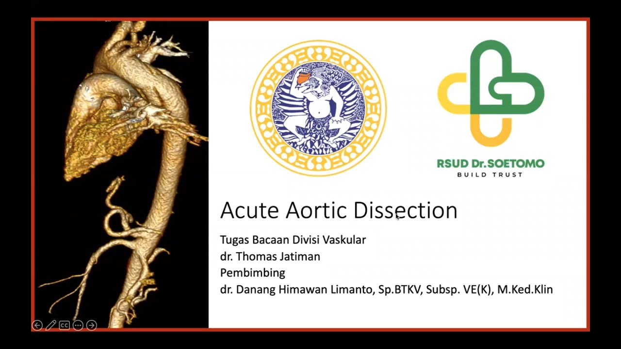 Acute Aortic Dissection - YouTube
