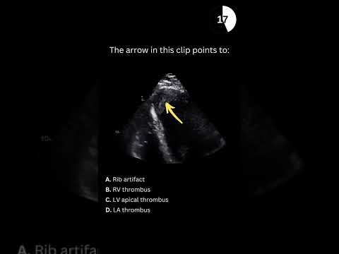 Echocardiography board practice question #02 - YouTube