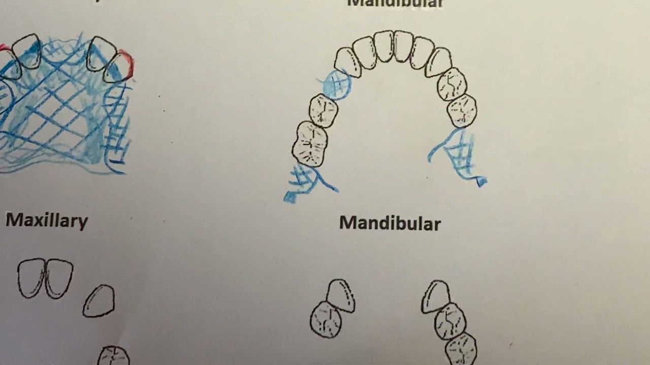 DENT 2004 Kennedy Class I Design Worksheet - YouTube