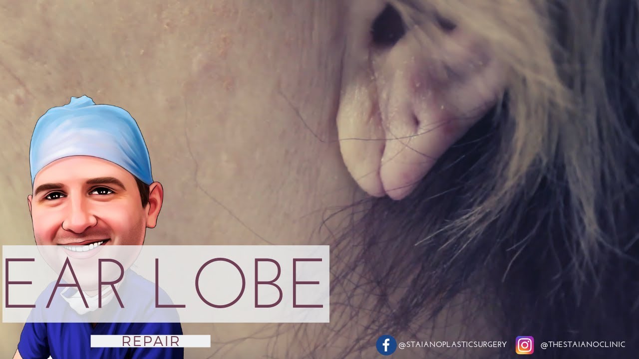 Split Earlobe Repair [LIVE SURGERY] - YouTube