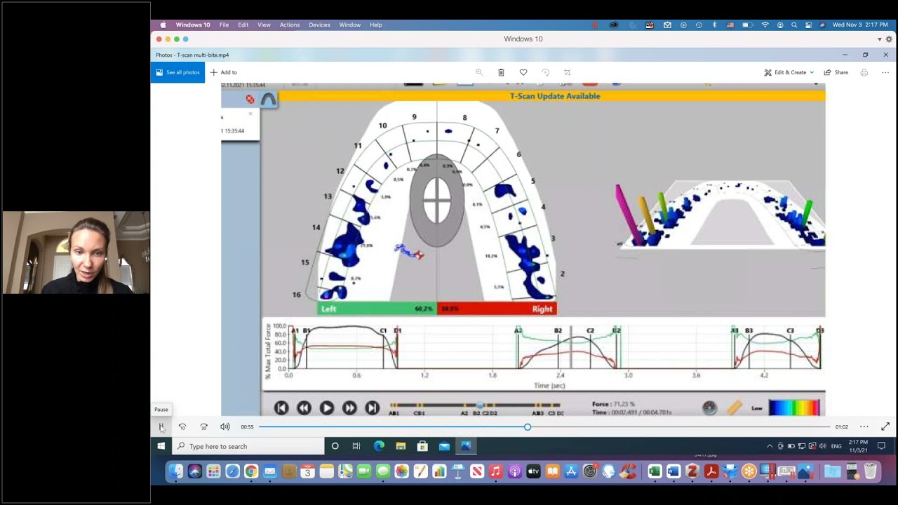 T-scan Multi- bite explained. Как интерпретировать данные записи Т-скан ...
