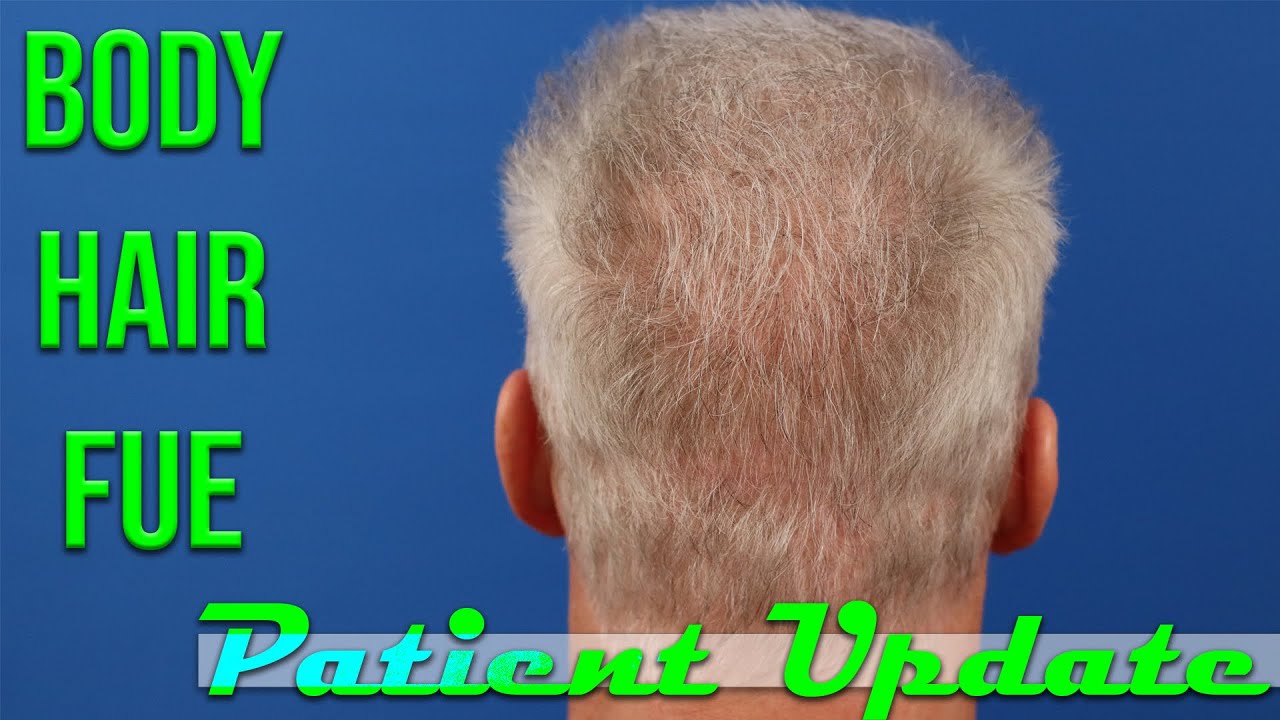 Body Hair Transplant - Results and Patient Update with Ricky - YouTube